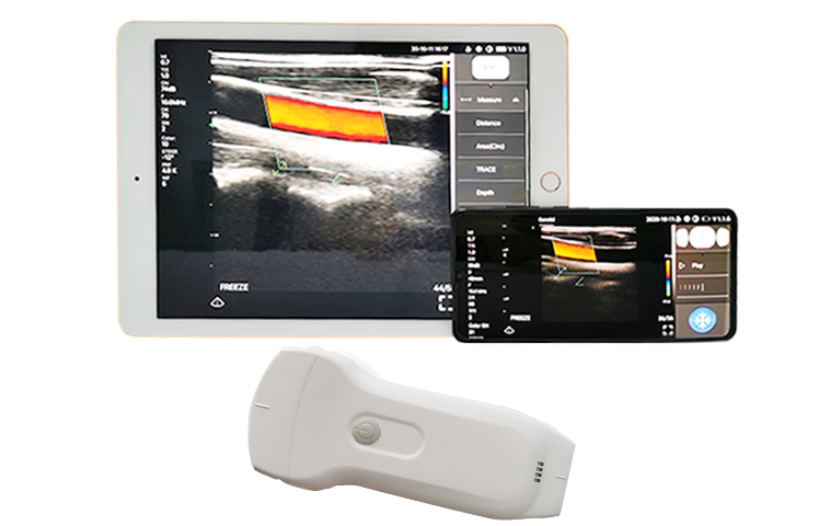 Portable Ultrasound | Handheld Ultrasound Machine - SonoHealth