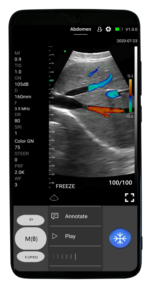 D5CL : Double Probes WiFi Ultrasound - SonoHealth